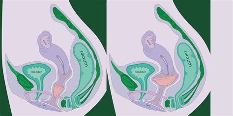 Menstrual Disc Brands Resources And Comparisons Period Nirvana