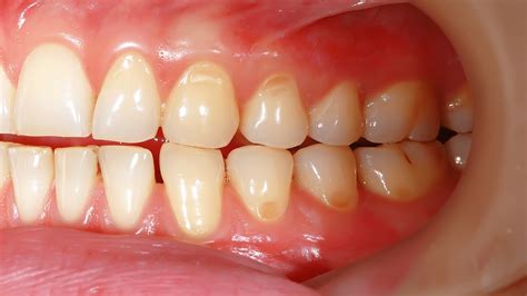 Repair Receding Gums At Home Healing And Repairing Receding Gums