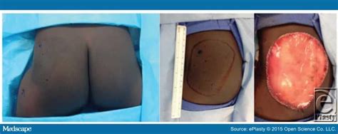 Congenital Nevus Removal