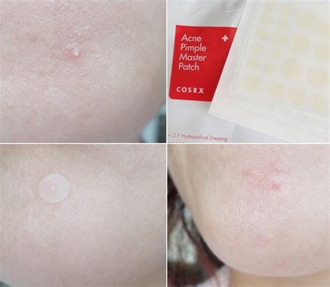Before And After Cosrx Pimple Patch Review Cosrx Pimple Master Patch Reviews How To Use It