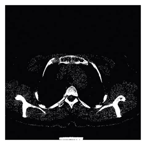 The Comparison Outcomes A Original Ct Image 6 B D Segmentation Download Scientific