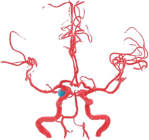 Surface Based 3d Deep Learning Framework For Segmentation Of Intracranial Aneurysms From Tof Mra