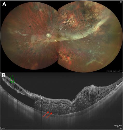 Subretinal Emulsified Silicone Oil In Rhegmatogenous Retinal Detachment Ophthalmology Retina