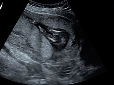 A Gender Reveal Ultrasound With An Extra Surprise