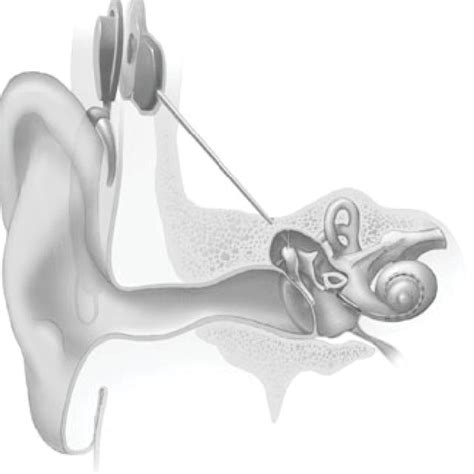 schematic diagram of a cochlear implant reproduced from national