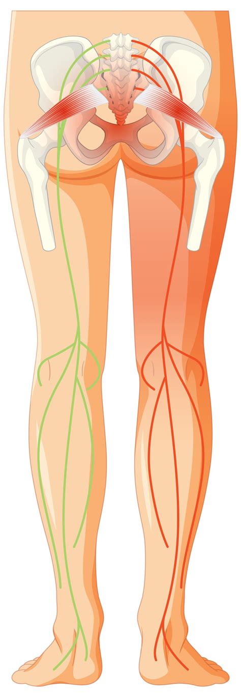 Увреждания на седалищния нерв АМАРАНТ ММ