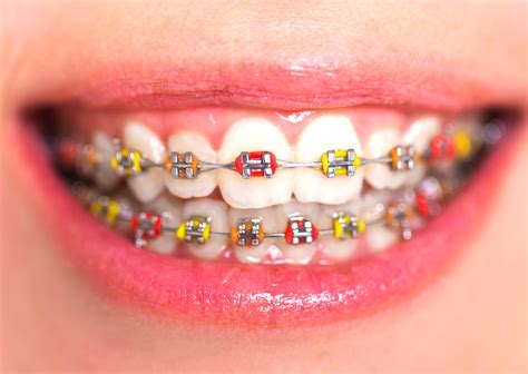 Fixed Braces In Southampton Octagon Dental Centre