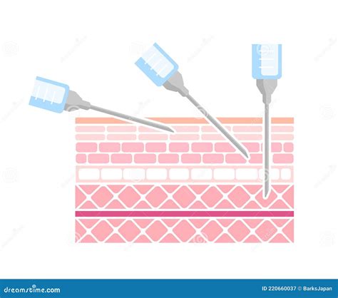 Angles For Inserting Injections Vector Illustration Stock Vector Illustration Of Procedure