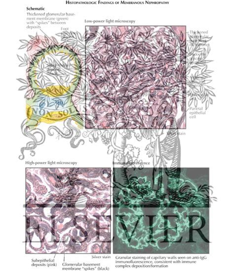Membranous Nephropathy Histopathologic Findings