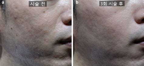 여드름 흉터에 피코프락셀 Mla 이 정말 효과 있나요 객관적인 증거를 보여주세요 네이버 블로그