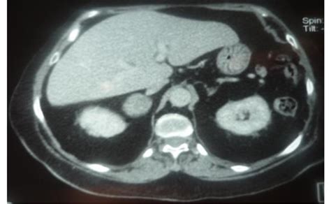 Adrenal Ct Scan Tumor Mass At The Right Adrenal Measuring 46 X 36mm Download Scientific