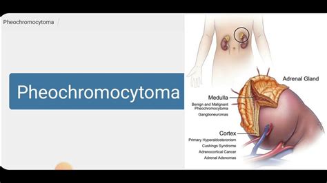 Pheochromocytoma Clinical Features Evaluation And Treatment Youtube