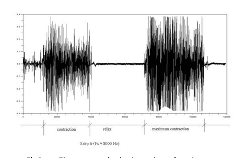 Figure 3 From Electromyography Emg Signal Compression Using Sinusoidal Segmental Model