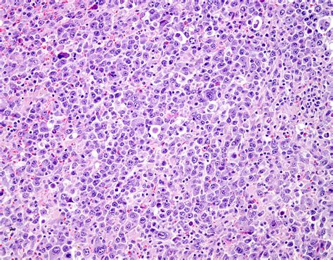 Diffuse Large B Cell Lymphoma Light … Bild Kaufen 13756467 Science Photo Library