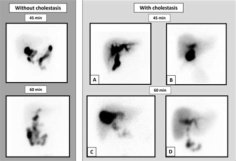 Cholestasis Eyes At Heriberto Barry Blog