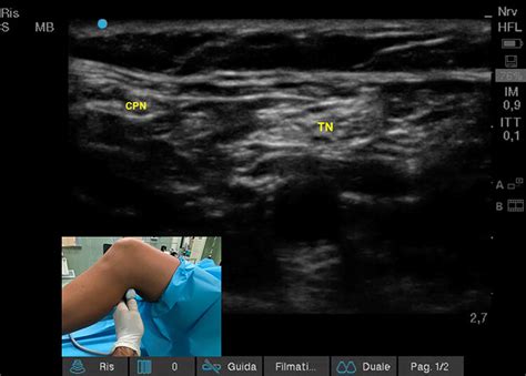 Emergency Ultrasound Case Sciatic Nerve Block In