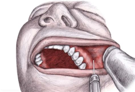 Local Anesthesia Maxillary Landmarks Flashcards Quizlet