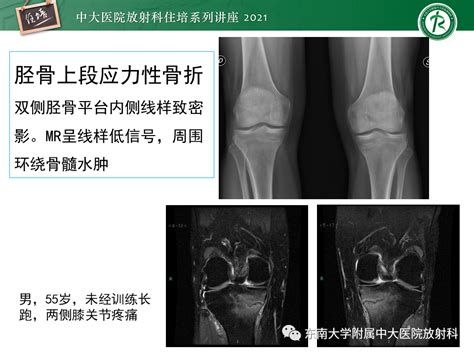 应力性骨折及与病理性骨折的鉴别诊断 骨折 诊断 鉴别 临床 健康界