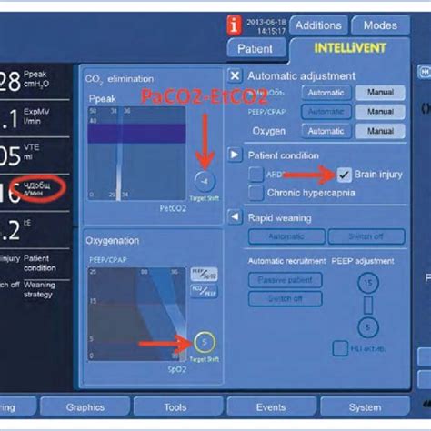 Settings Of Ventilation Parameters In Intellivent Mode Download Scientific Diagram
