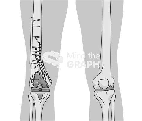 Failed Open Reduction Internal Fixation Periprosthetic Fracture Total Knee Arthroplasty Body