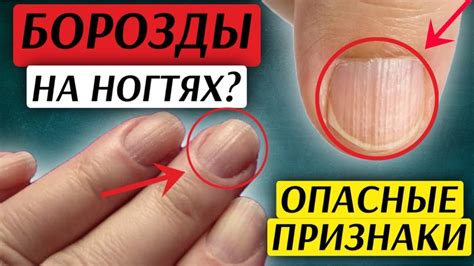ВЕРТИКАЛЬНЫЕ БОРОЗДЫ НА НОГТЯХ ЭТО МОЖЕТ СИГНАЛИЗИРОВАТЬ О СЕРЬЕЗНЫХ ПРОБЛЕМАХ Узнайте каких