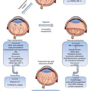 Pdf Understanding Retinopathy Of Prematurity Update On Pathogenesis