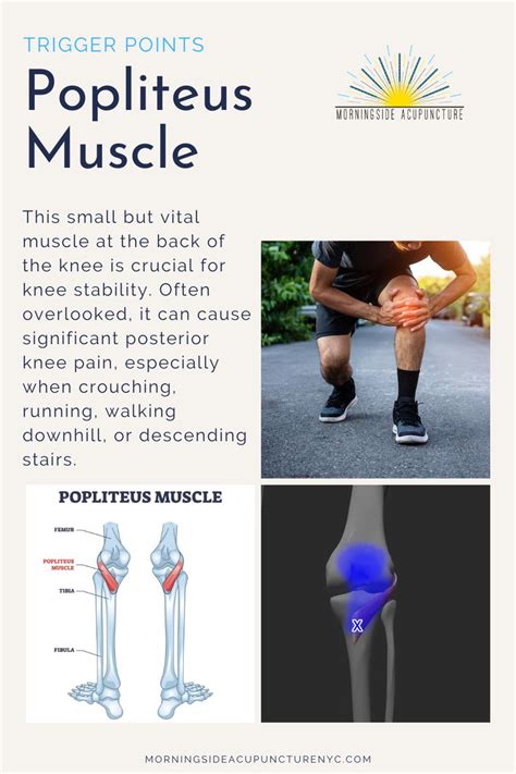 Popliteus Muscle Trigger Points In 2025 Posterior Knee Pain Muscle Pain Acupuncture