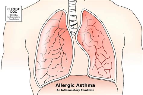 Allergic Asthma Tcm Alternative Treatments