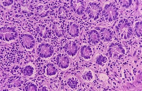 Sarcoma Awareness Month A Deep Dive Into Desmoid 2024 Vccc Alliance