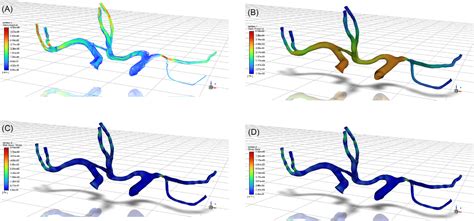 Computational Fluid Dynamics In Intracranial Atherosclerotic Disease
