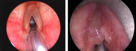 Polypoid Corditis Reinkes Oedema