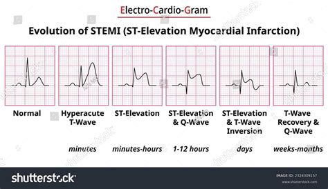 Vektor Stok Myocardial Infarction Icon Symptoms Treat