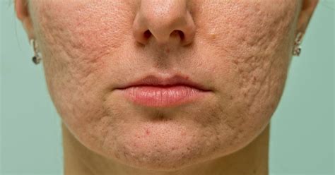 Roaccutane Side Effects 9 Women Share Their Roaccutane Experiences