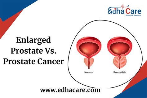 Enlarged Prostate Cancer Support家支援