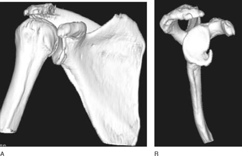 2 Glenoid Fracture Musculoskeletal Key