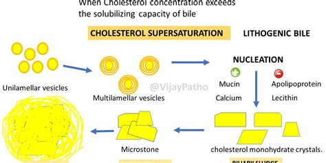 Gall Stones Cholelithiasis Pathogenesis Pathology Made Simple