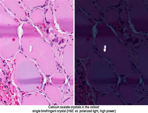Pathology Outlines Calcification