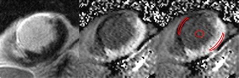 T 1 Mapping Lge Image In Short Axis View Left With Corresponding T
