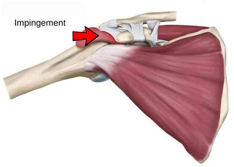 Bursitis Dr Oscar Brumby Rendell Orthopaedic Surgeon Adelaide