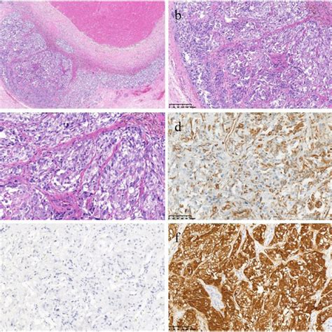 Tte No Motion In The Basal And Mid Segments Of The Left Ventricle But Download Scientific