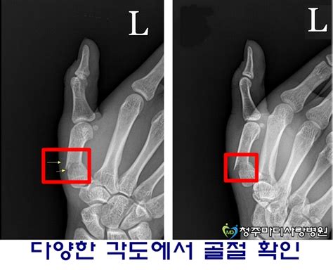 마디사랑병원 커뮤니티 마디사랑병원블로그