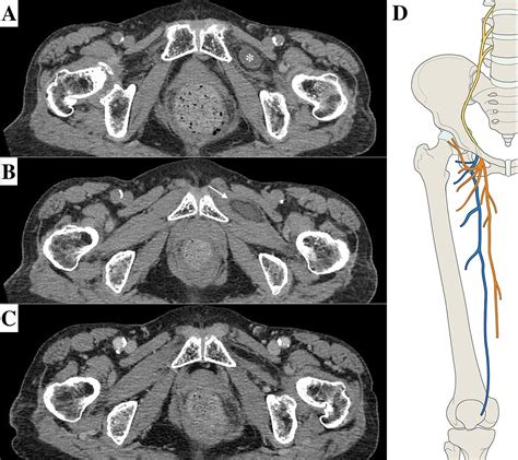Hernia Obturator