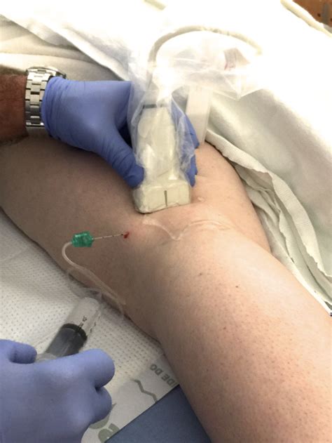 Popliteal Block — Twin Oaks Anesthesia Courses