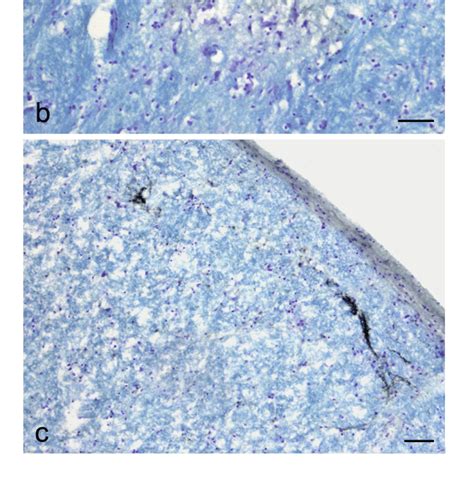 Adult Case 9 Right Dorsal Quadrant Of Caudal Medulla Oblongata Download Scientific Diagram