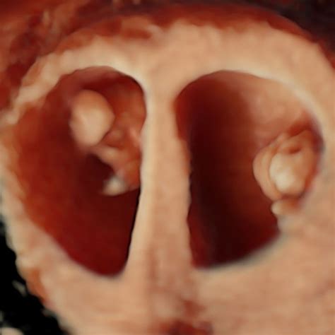 Viability Scan And Dating Scan London Pregnancy Clinic