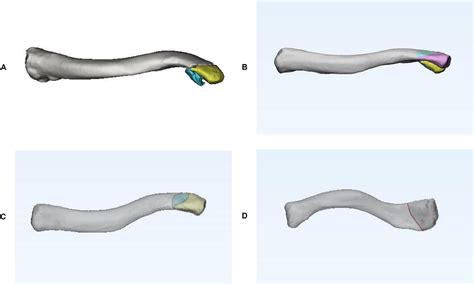 Three‐dimensional Mapping Of Distal Clavicle Fractures Displacement Patterns And Clinical