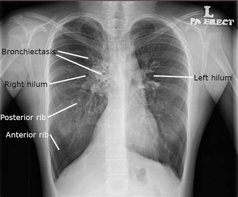 Bronchiectasis Chest X Ray Tram Track At Mike Modzelewski Blog