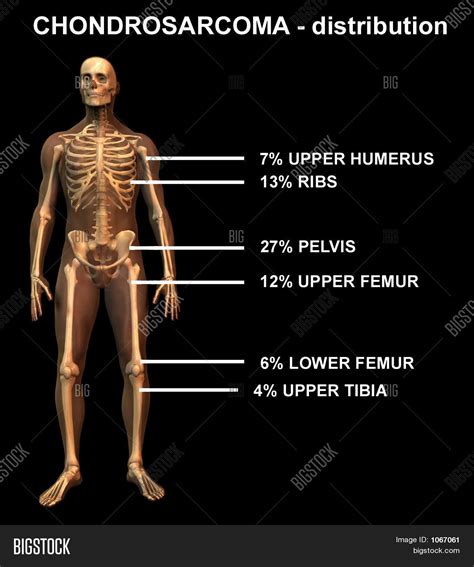 Chondrosarcoma Image Photo Free Trial Bigstock