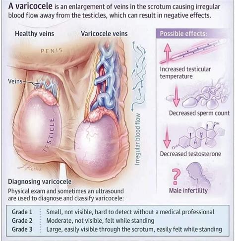 Varicocele Healing Ltd On Linkedin Varicocele Infertility