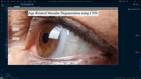 Age Related Macular Disease Detection Using Cnn